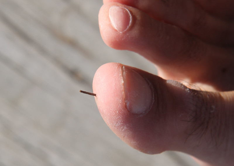 Foreign Body Treatment - Feet For Life - Removal & Treatment of Objects